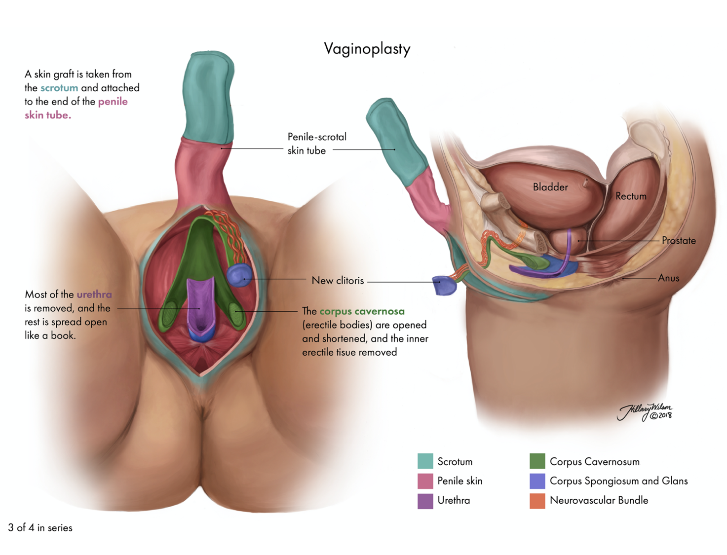 Preparing For Gender Affirming Genital Surgery University Of Iowa